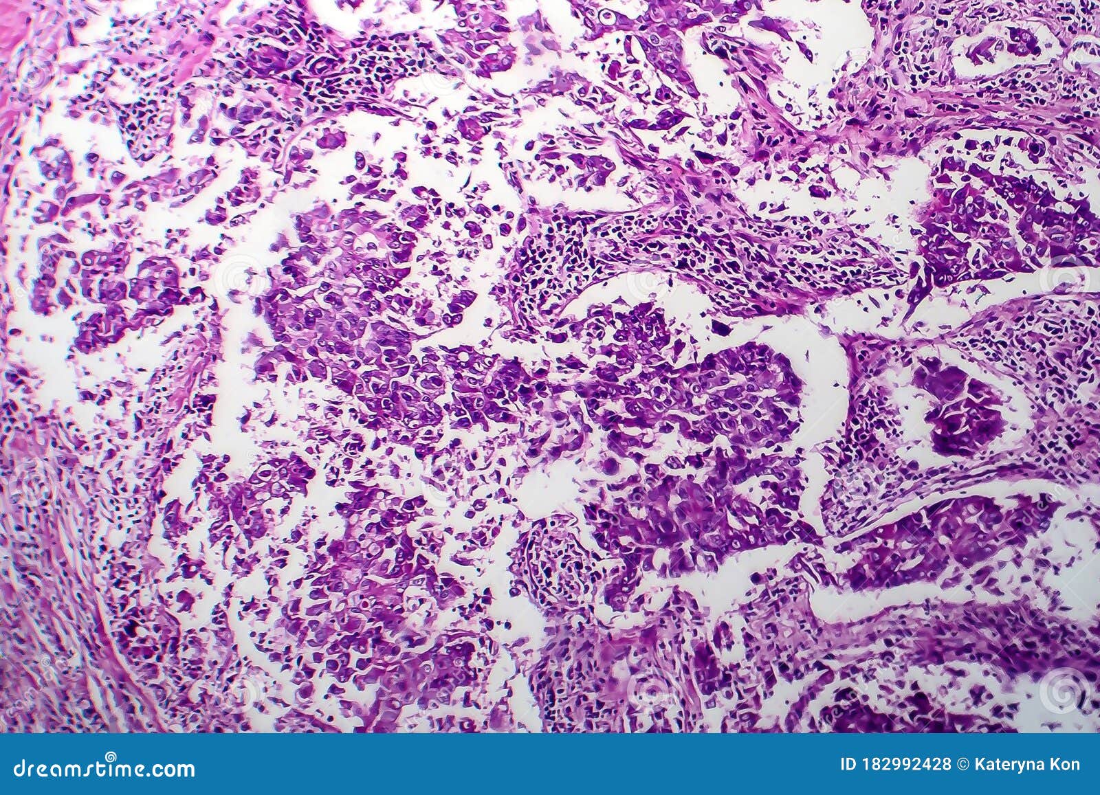 Breast Ductal Carcinoma, Light Micrograph Stock Photo - Image of cancer ...