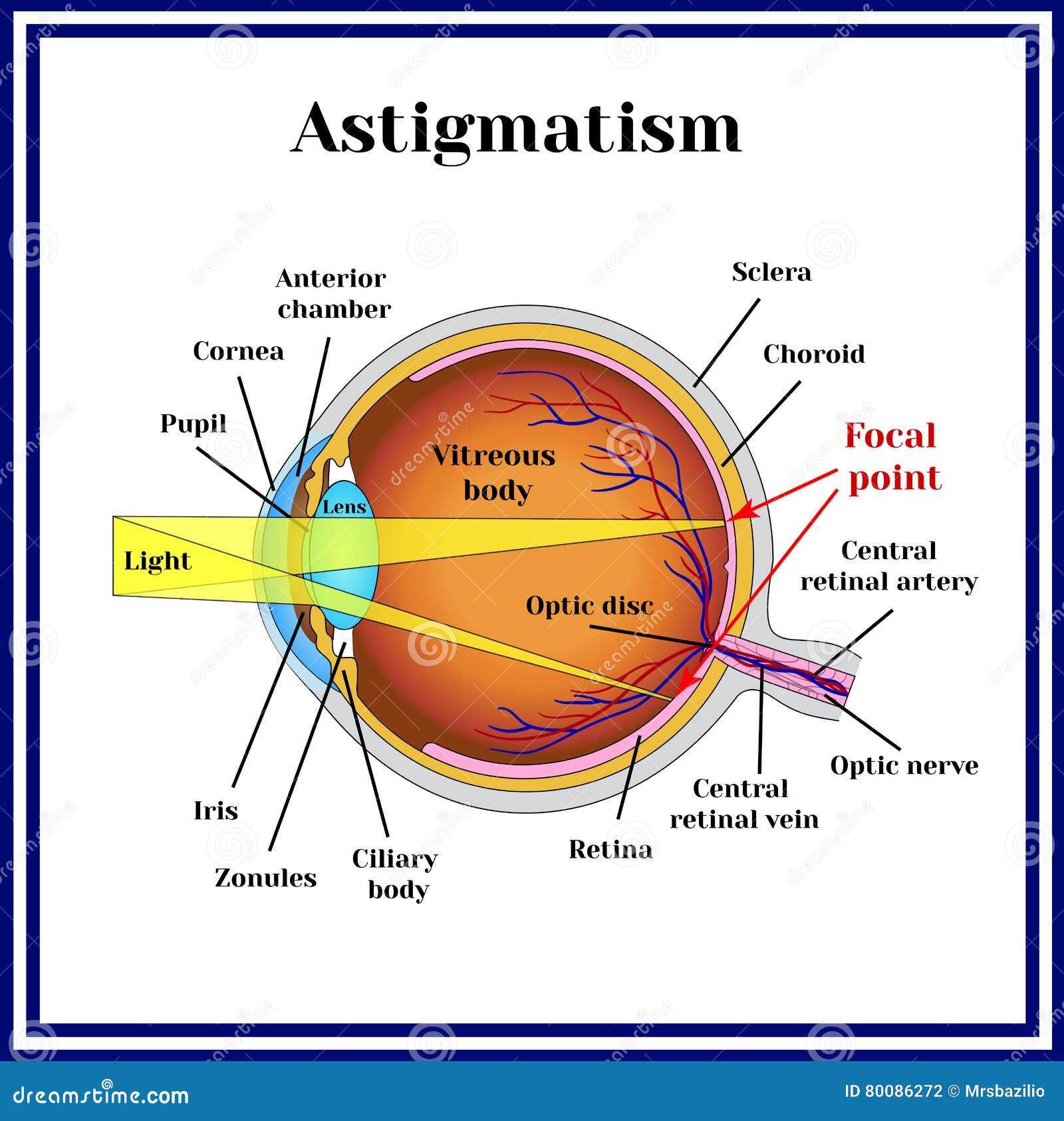 Brechender Fehleraugapfel Astigmatismus Medizin Vektor Abbildung ...