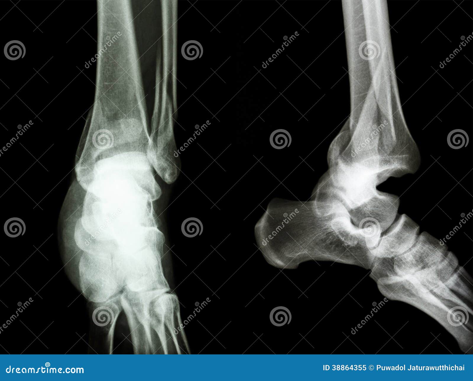 Breuk Distale Scheenbeen En Fibula (het Been Van Het Been) Stock ...