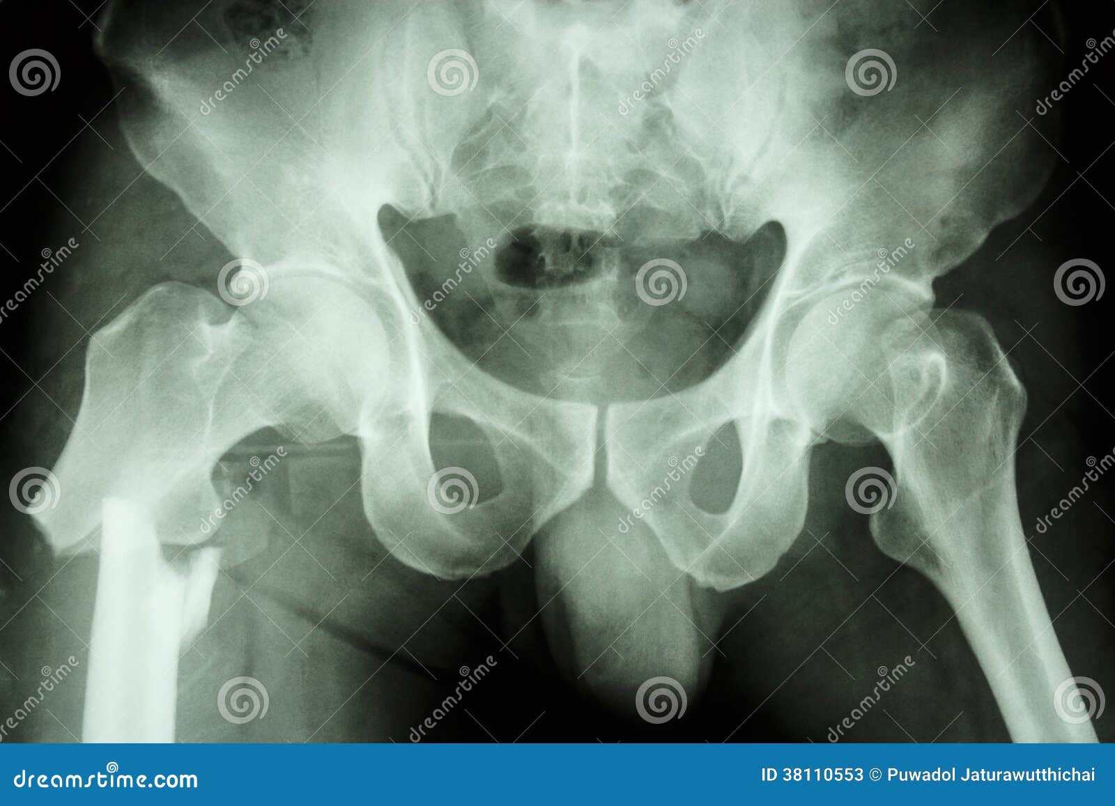 Breuk Juist Dijbeen (het Been Van De Dij) Stock Afbeelding - Image of ...