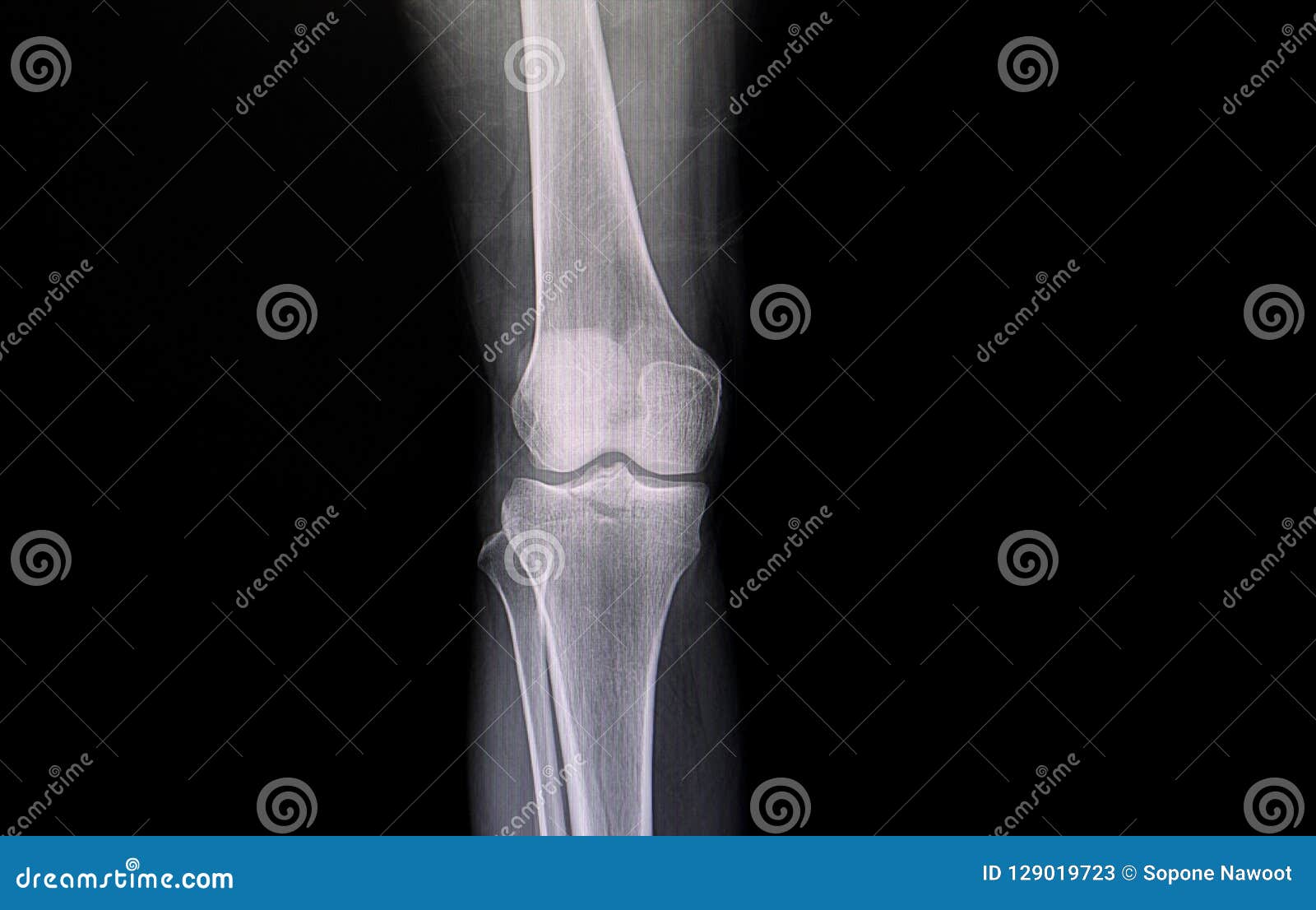 Breuk tibial plateau stock afbeelding. Image of orthopedisch - 129019723