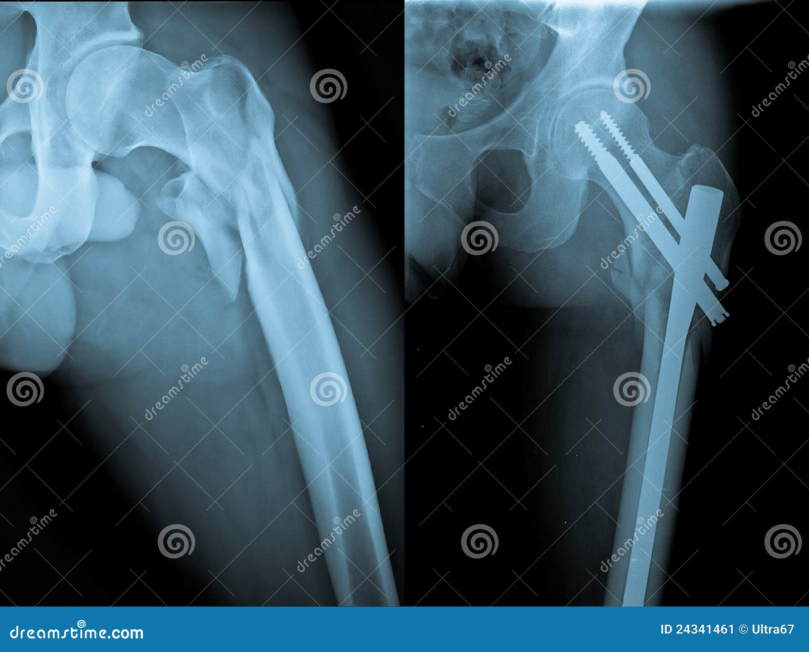 Breuk van dijbeen stock afbeelding. Image of geduldig - 24341461