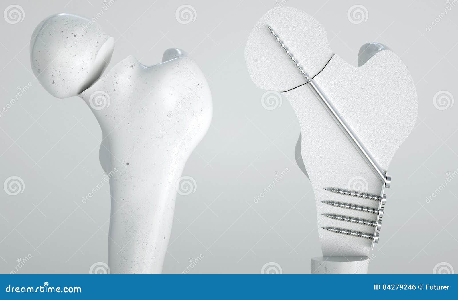 Breuk Van Het Dijbeen - Behandeling Met Schroeven - Het 3D Teruggeven ...