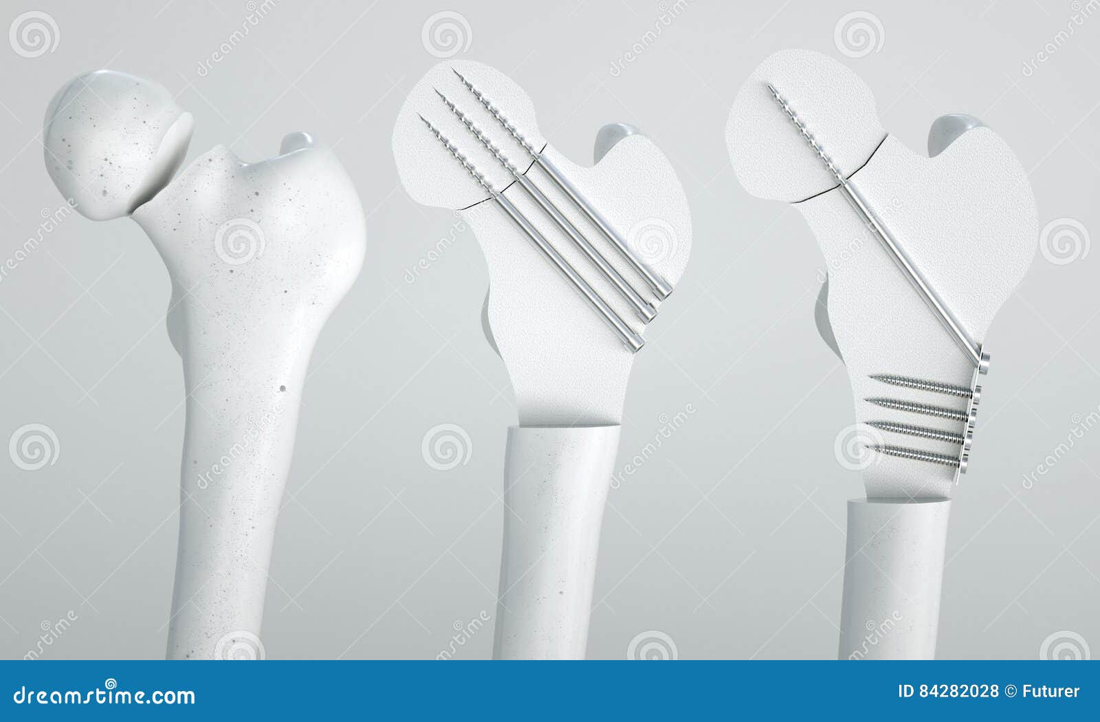 Breuk Van Het Dijbeen - Behandeling Met Schroeven - Het 3D Teruggeven ...