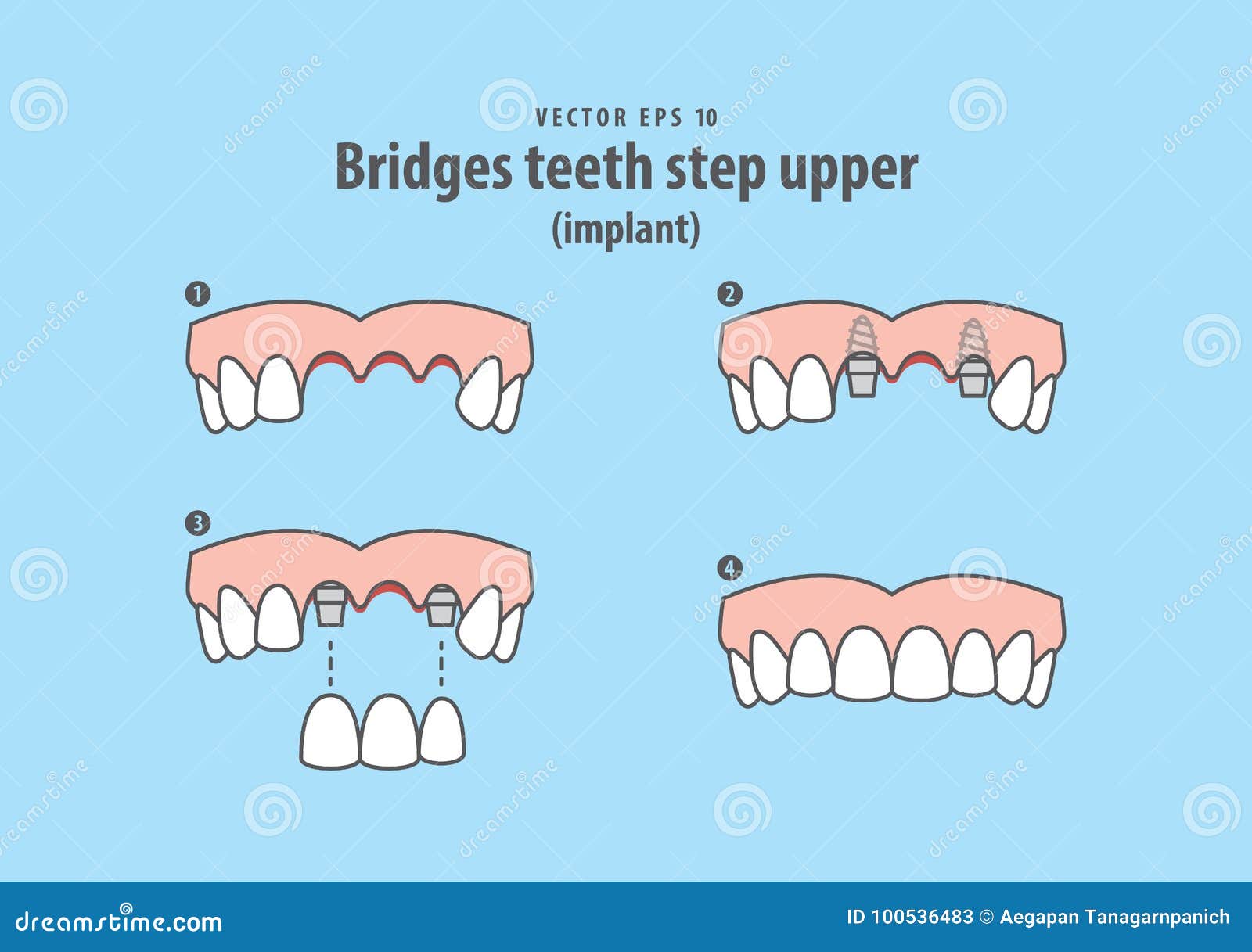 Bridges Teeth Step Upper Implant Illustration Vector on Blue B Stock ...