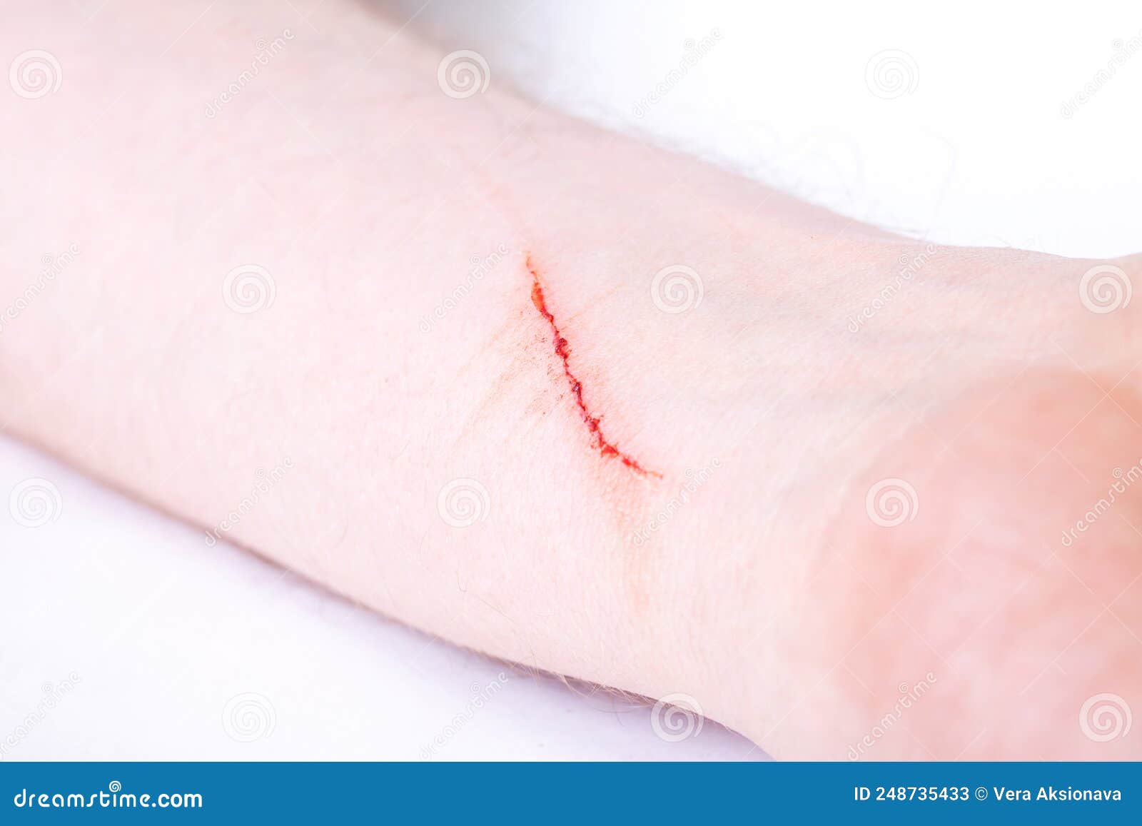 Bright Scratch on the Arm Close Up Stock Image - Image of side ...