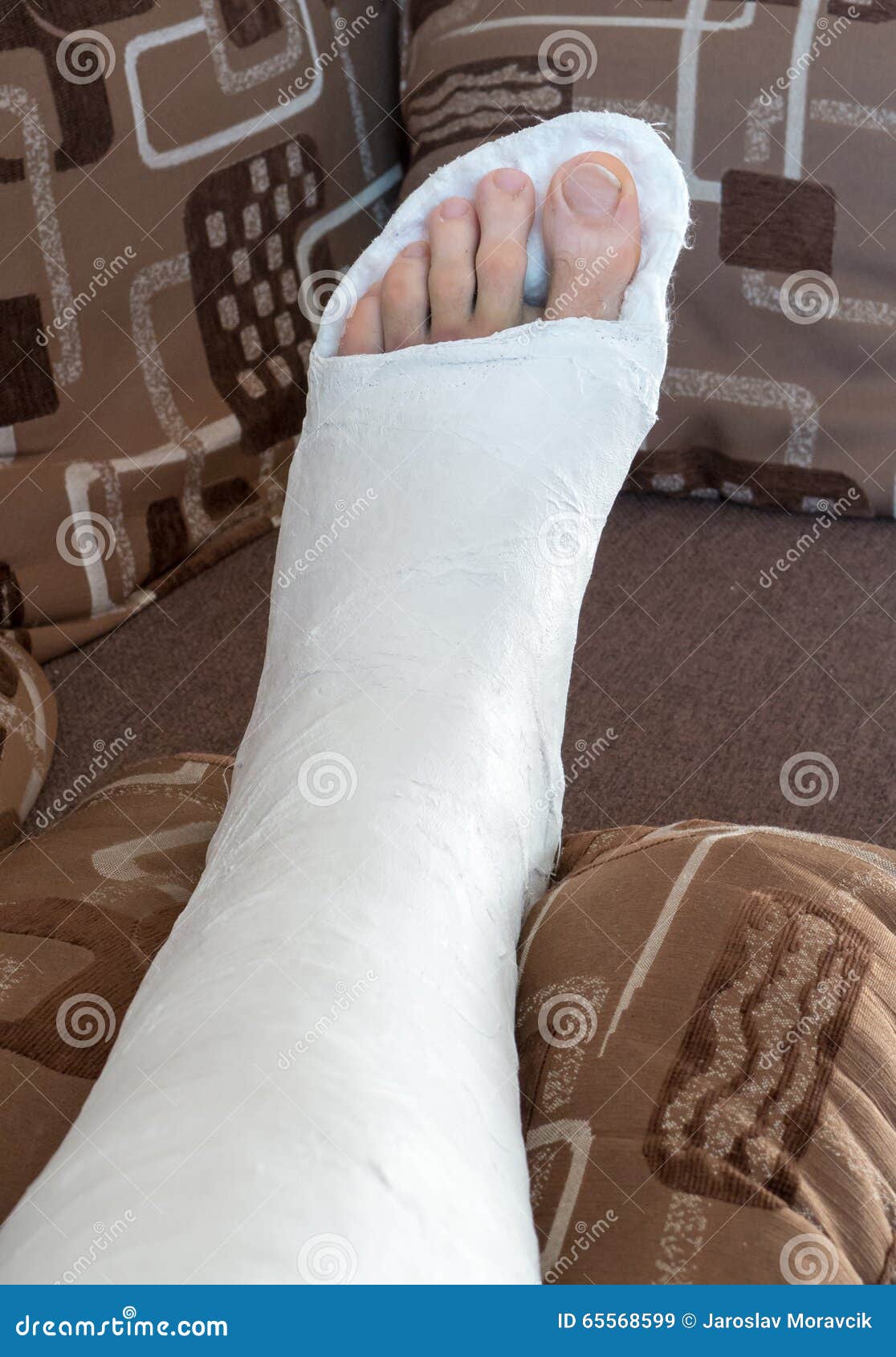 Broken ankle in gypsum stock image. Image of accident - 65568599