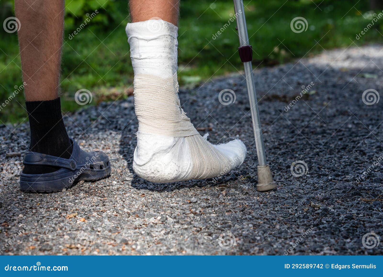 Broken Ankle and a Leg Cast. Leg Splint. Stock Photo - Image of broken ...