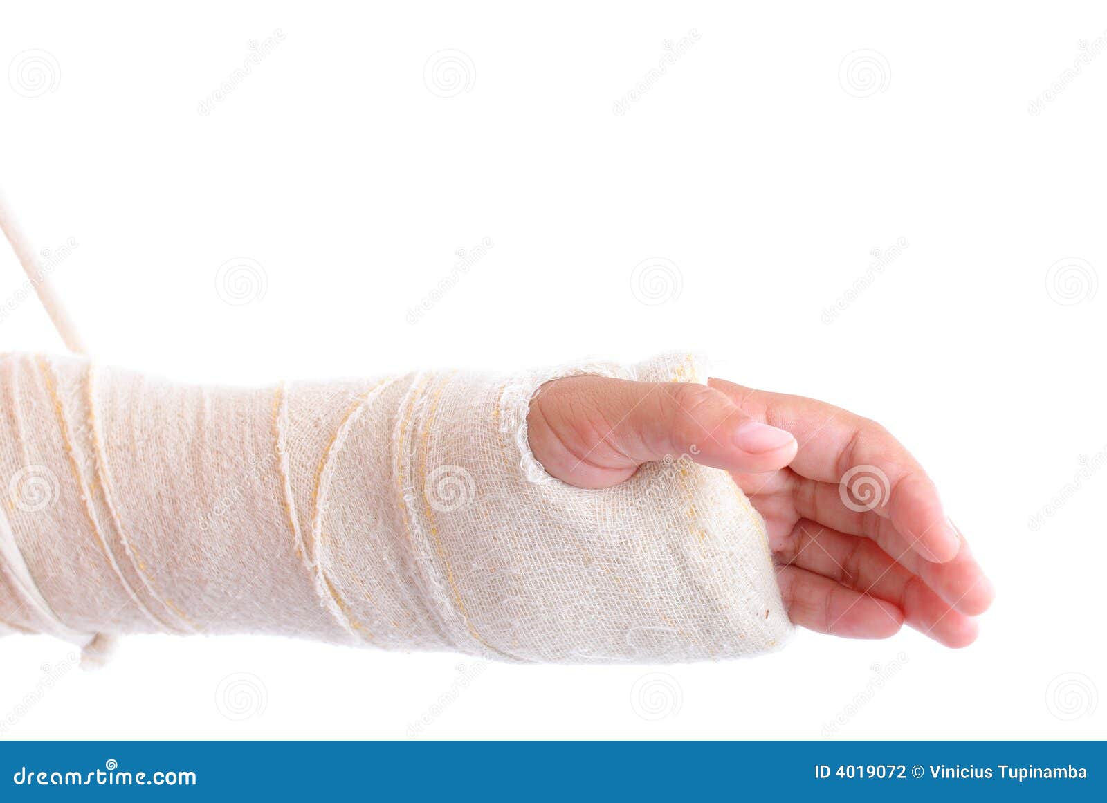 Broken Arm stock photo. Image of swollen, arms, healthcare - 4019072