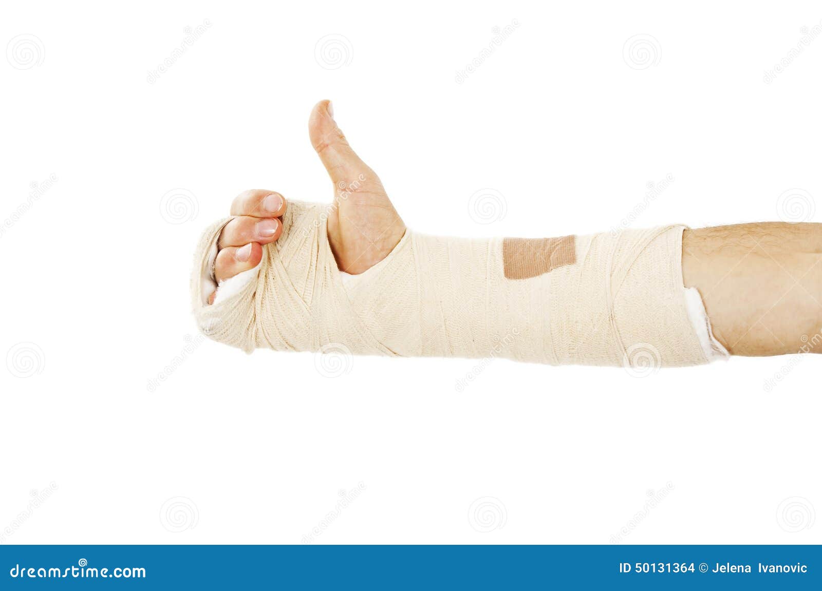 Broken Arm Bone in Cast Making OK Sign Stock Photo - Image of accident ...