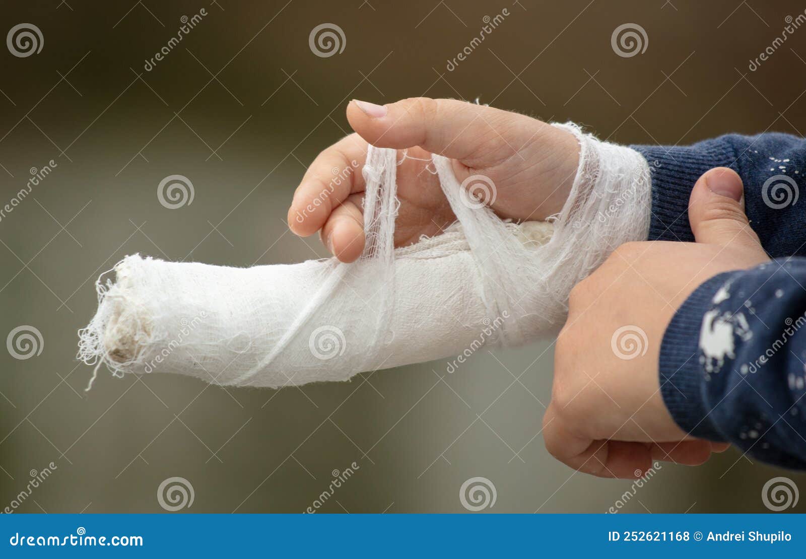 Broken Arm in a Cast in a Boy. Stock Photo - Image of bone, patient ...