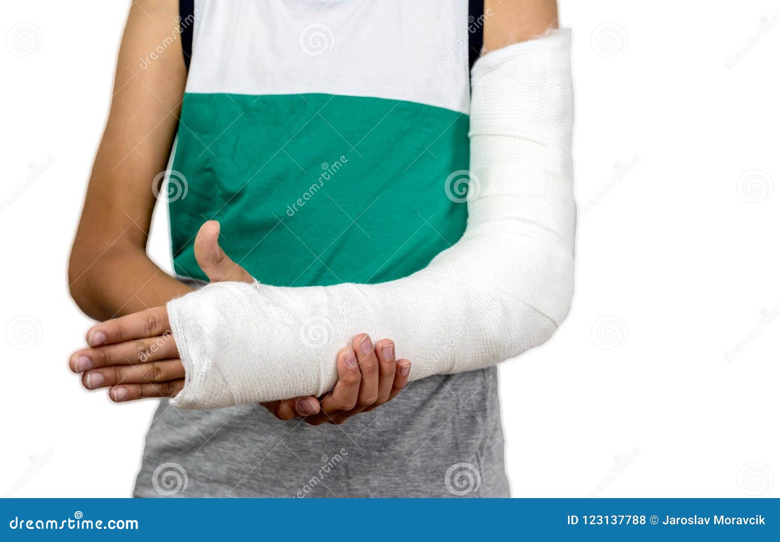 Broken Shoulder Cast