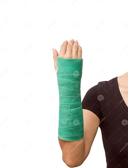 Broken Arm with Green Cast on White Background Stock Image - Image of ...