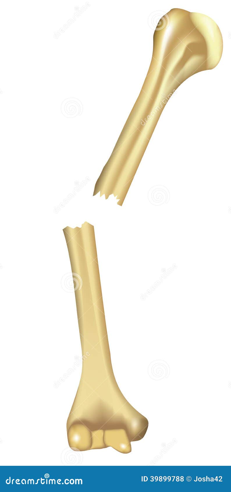 Fractured Humerus, Vintage Illustration Cartoon Vector | CartoonDealer ...