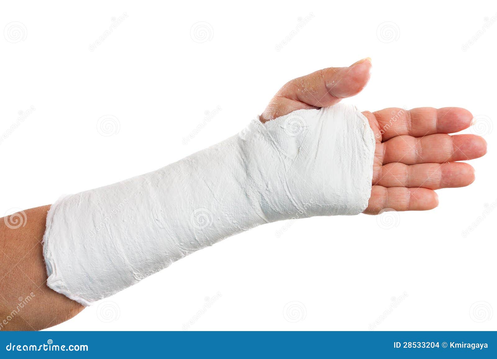 Broken Arm with a Plaster Cast Stock Photo - Image of emergency, injury ... Broken Arm with a Plaster Cast Stock Photo - Image of emergency, injury ...
