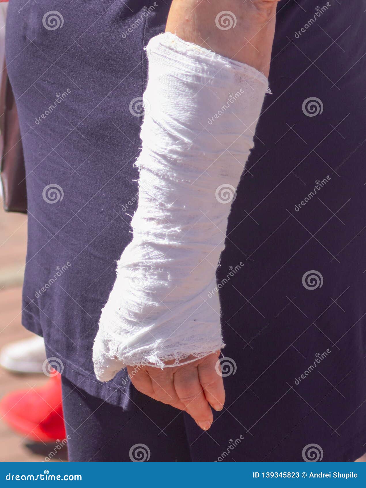 A Broken Arm in a Woman`s Cast Stock Image - Image of human, medical ...
