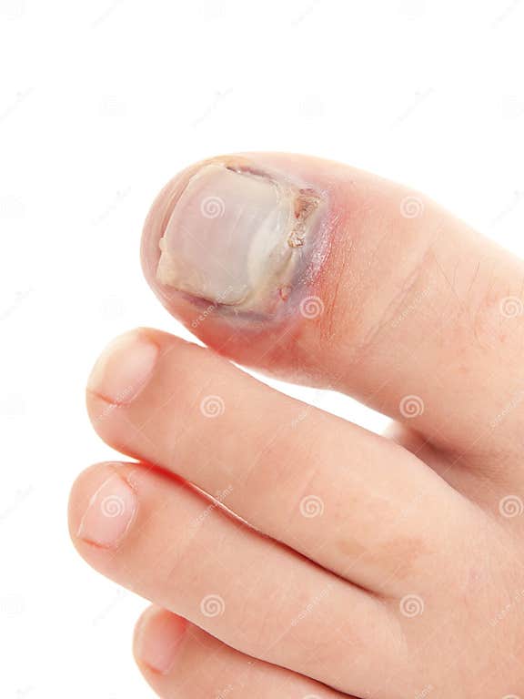 Broken Big Toe with Nail Detachment Stock Photo - Image of injured ...