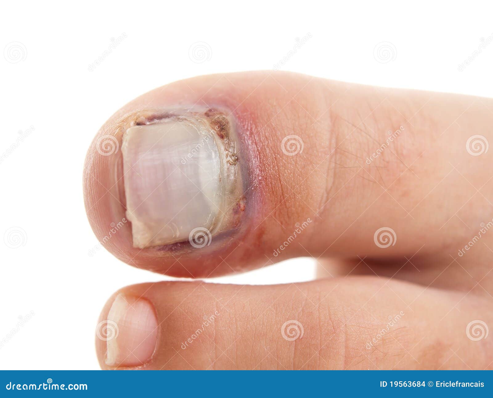 Broken Big Toe with Nail Detachment Stock Photo - Image of nail ...
