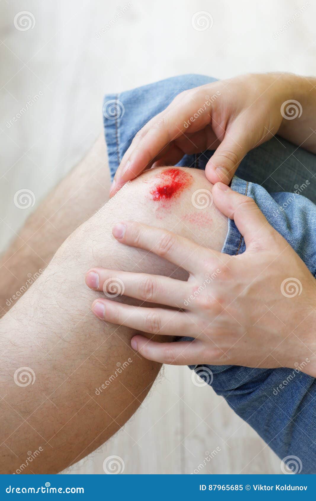 Broken Bleeding Knee With Deep Scratches On The Skin With Wet Tracks ...