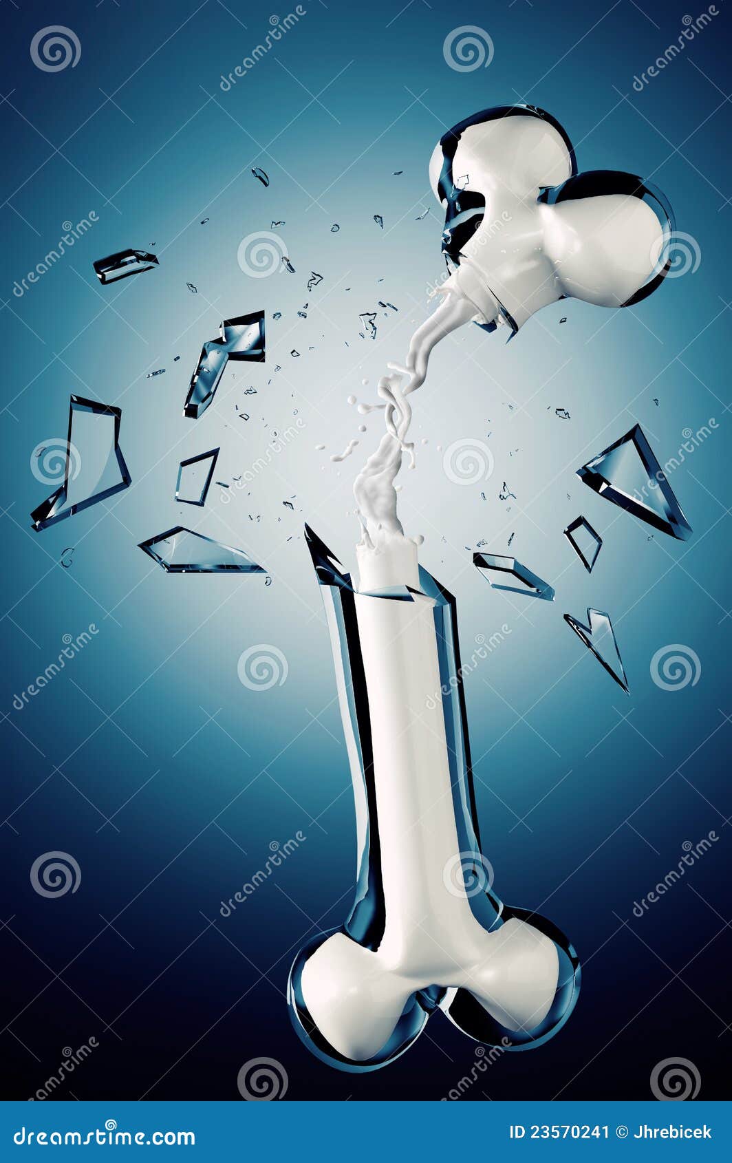 Broken Leg, Bone Fracture, Orthopedic Plaster Cast, Trauma ...