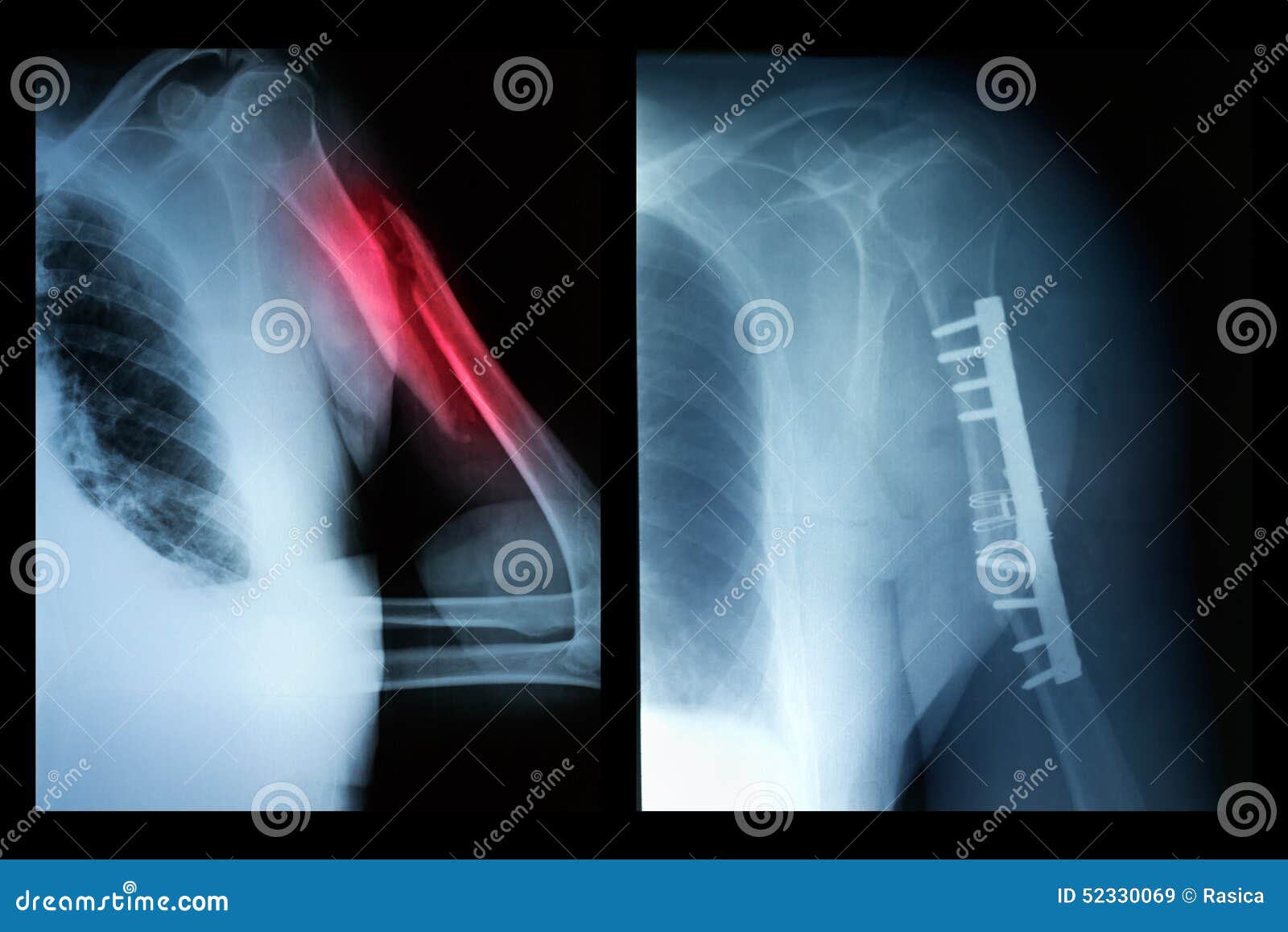 Broken Bone before and after Surgical Intervention Stock Image - Image ...
