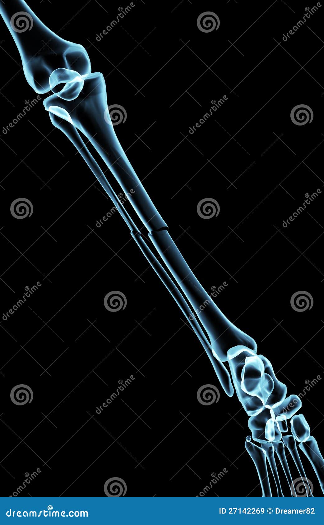 Broken Leg, Bone Fracture, Orthopedic Plaster Cast, Trauma ...