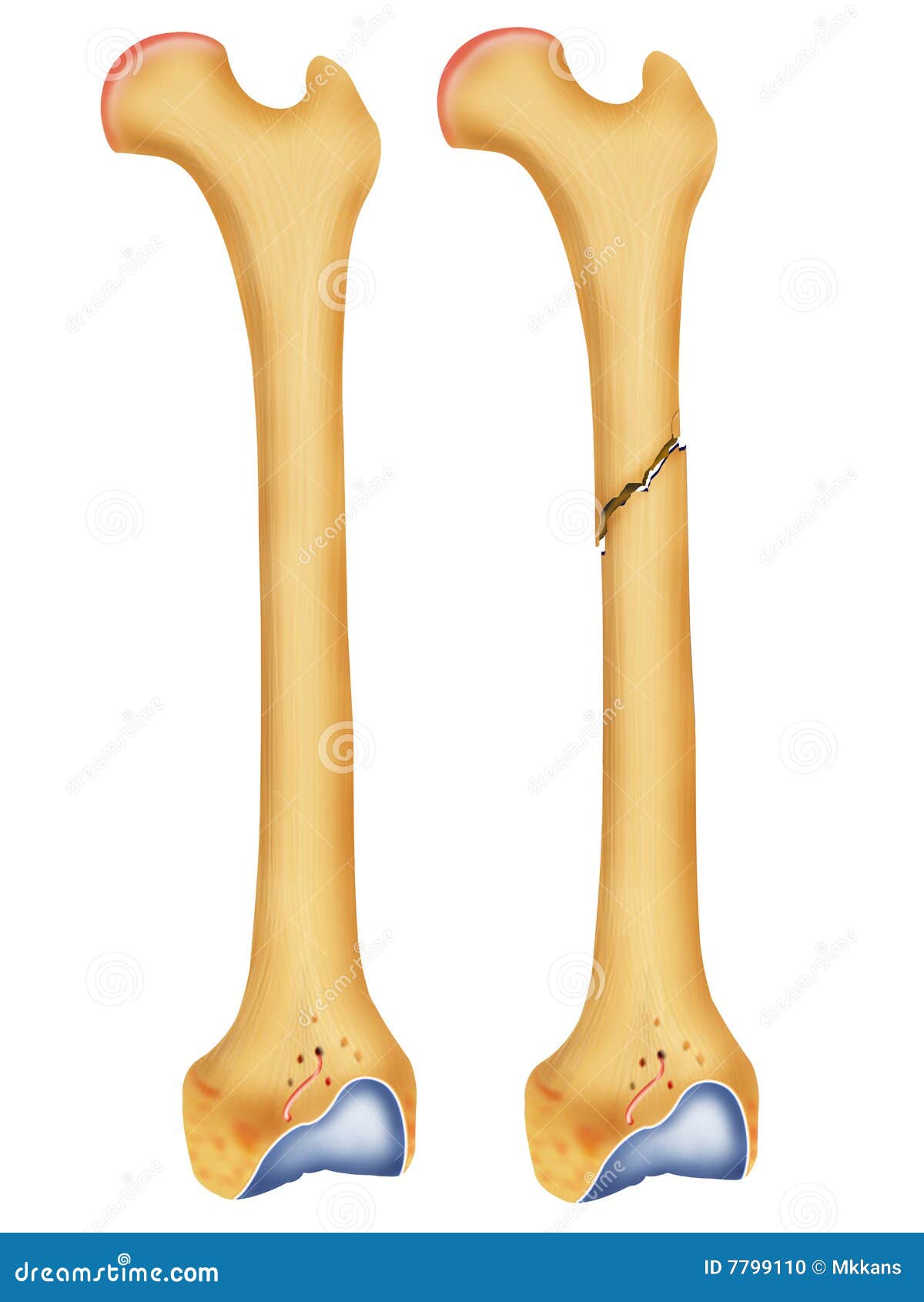 Broken Bones stock illustration. Illustration of legs - 7799110