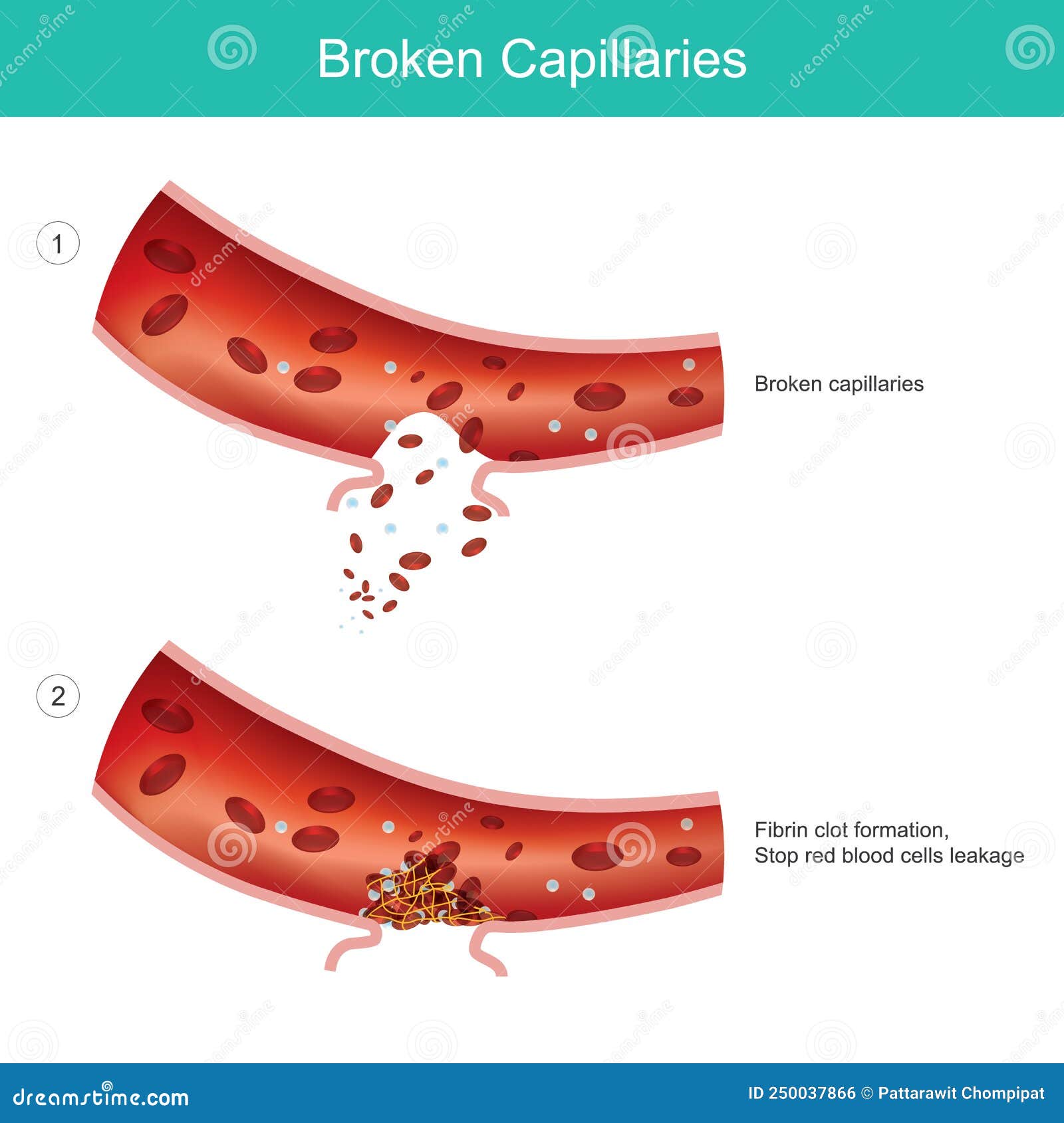 Broken capillaries. stock vector. Illustration of leaking - 250037866
