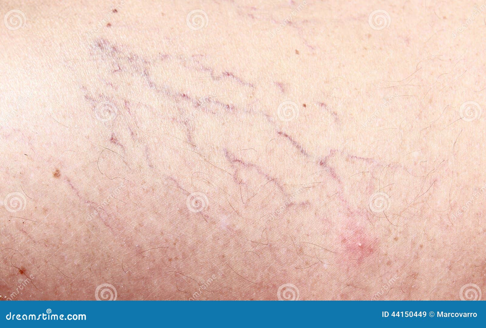 Broken Capillaries closeup stock image. Image of vein - 44150449