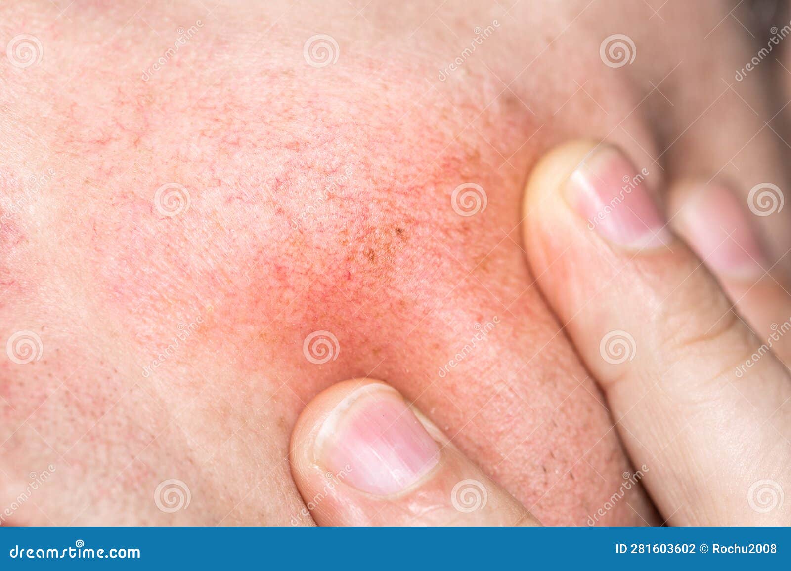 Broken Capillaries on the Face, Red Skin Problems, Congested Skin. the ...