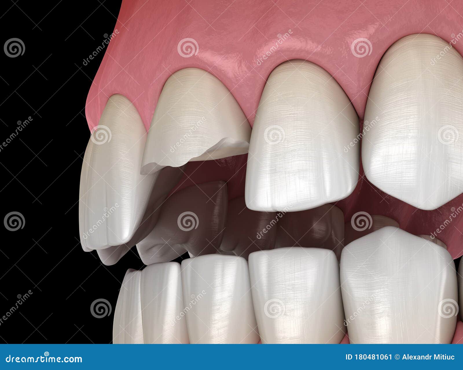 Broken Central Incisor Tooth. Medically Accurate 3D Illustration of ...