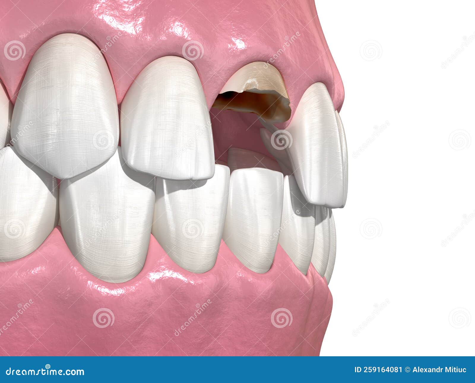 Broken Central Incisor Tooth. Medically Accurate 3D Illustration of ...