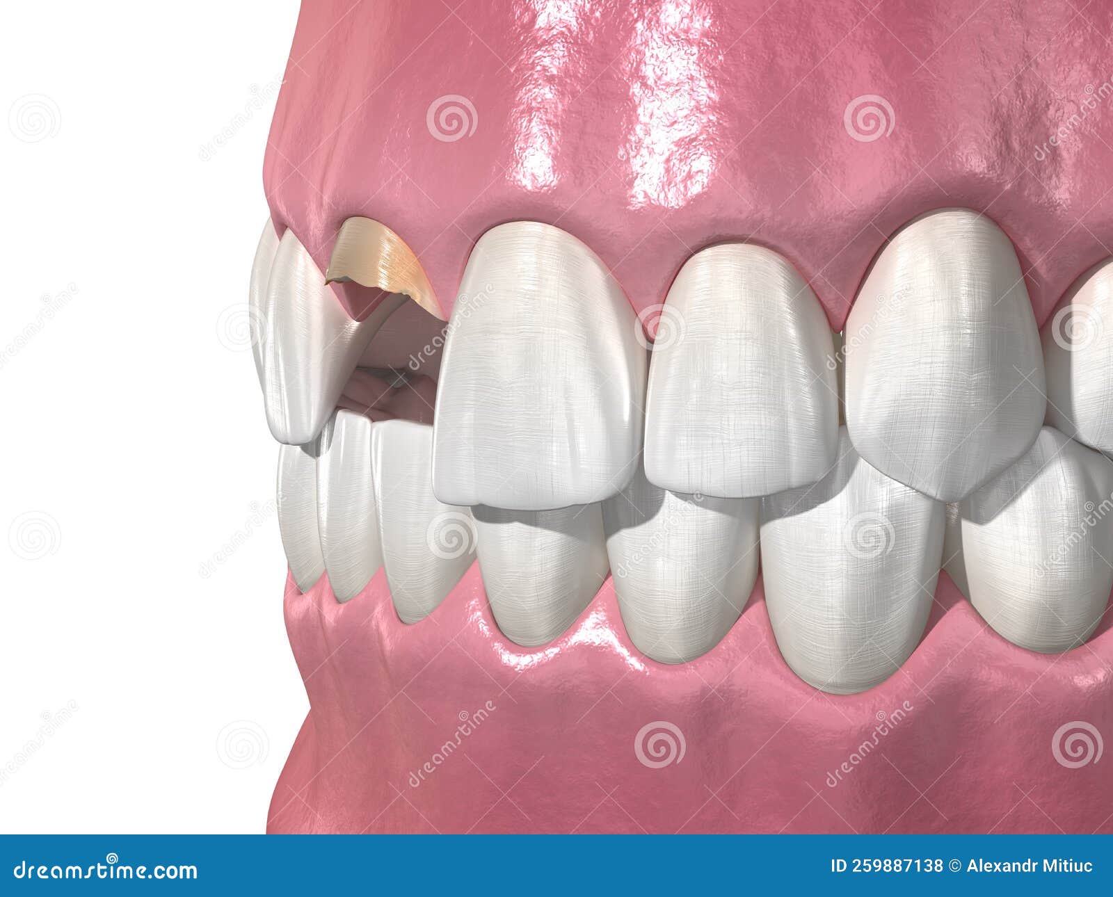 Broken Central Incisor Tooth. Medically Accurate 3D Illustration of ...