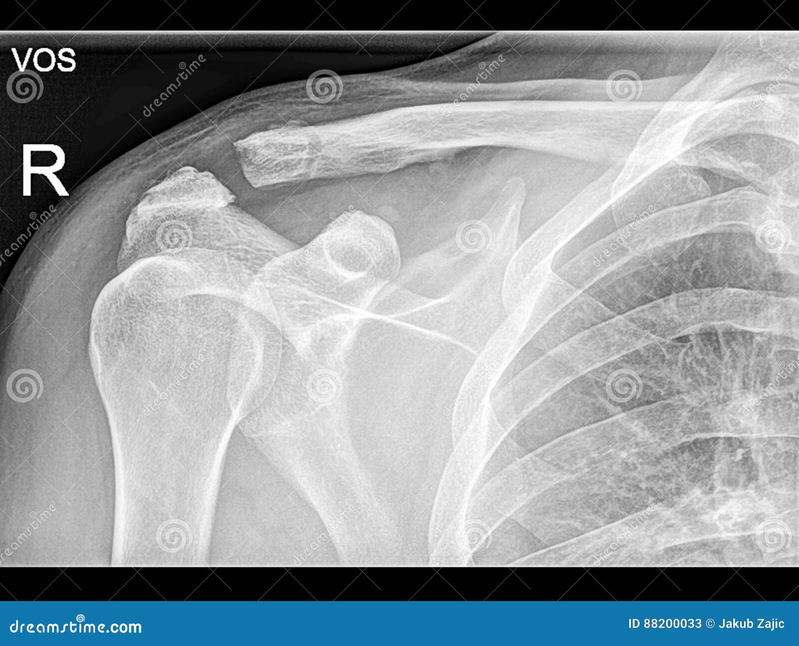 Broken Clavicle Bone Fixation, Fracture Repair Stock Image - Image of ...