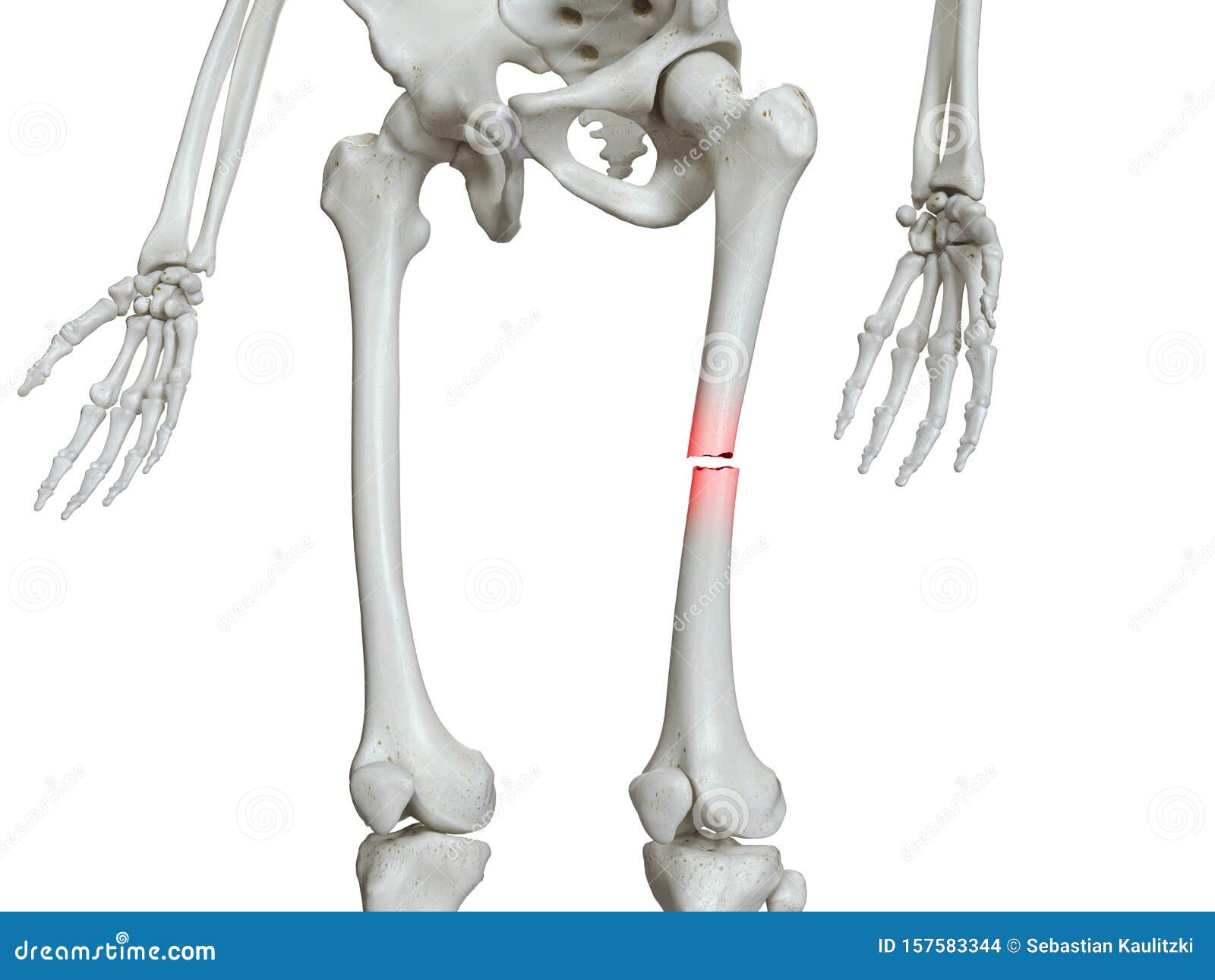 A broken femur stock illustration. Illustration of health - 157583344