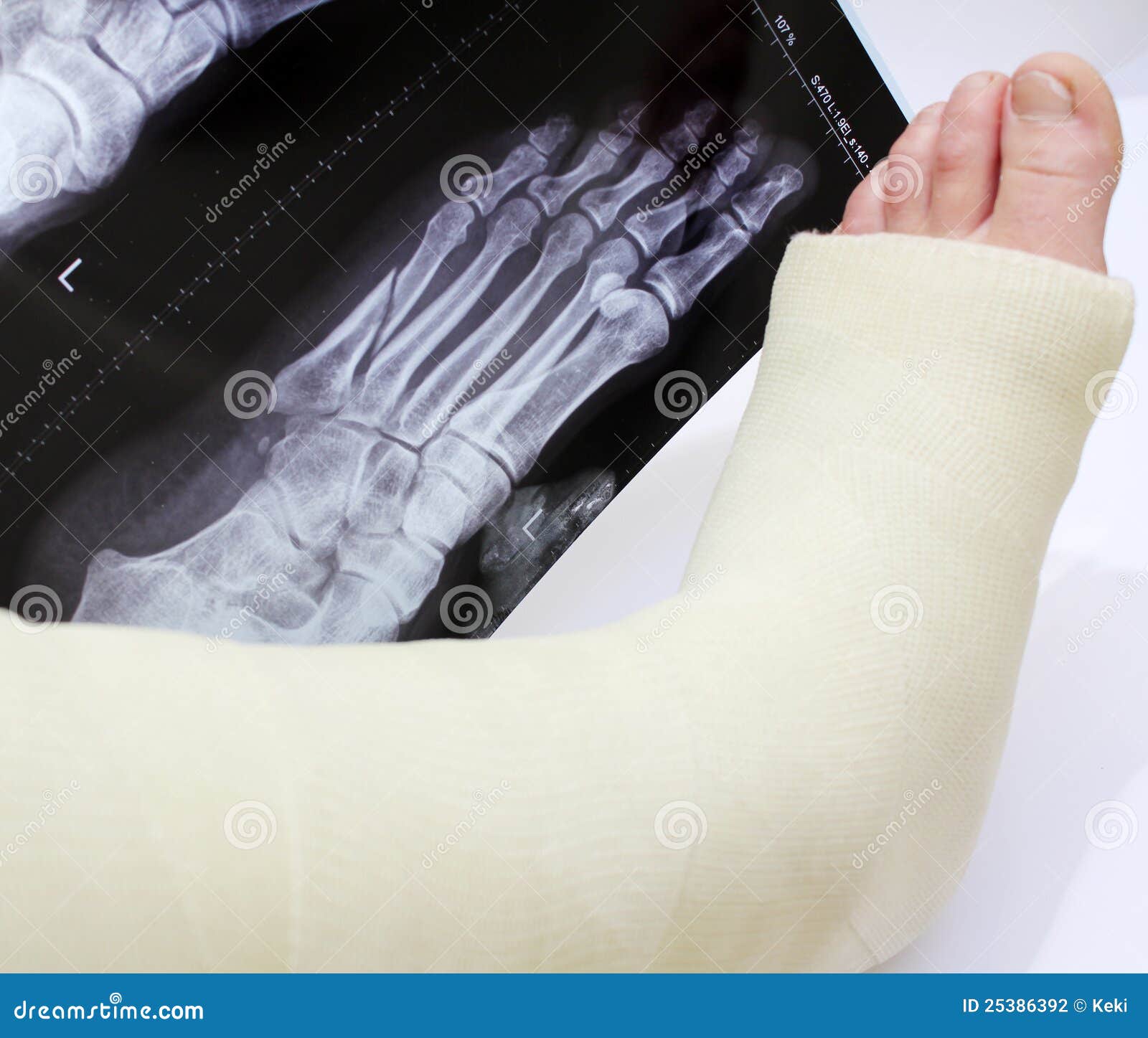 Broken foot stock photo. Image of broke, pain, safety - 25386392