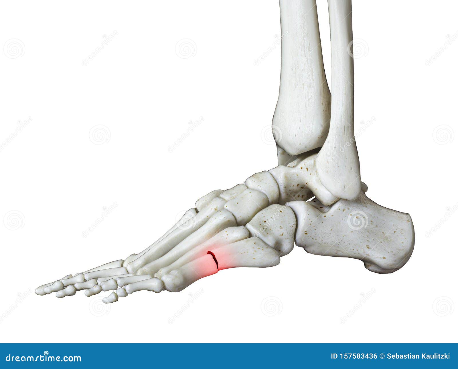 A Broken Foot Royalty-Free Cartoon | CartoonDealer.com #157583432