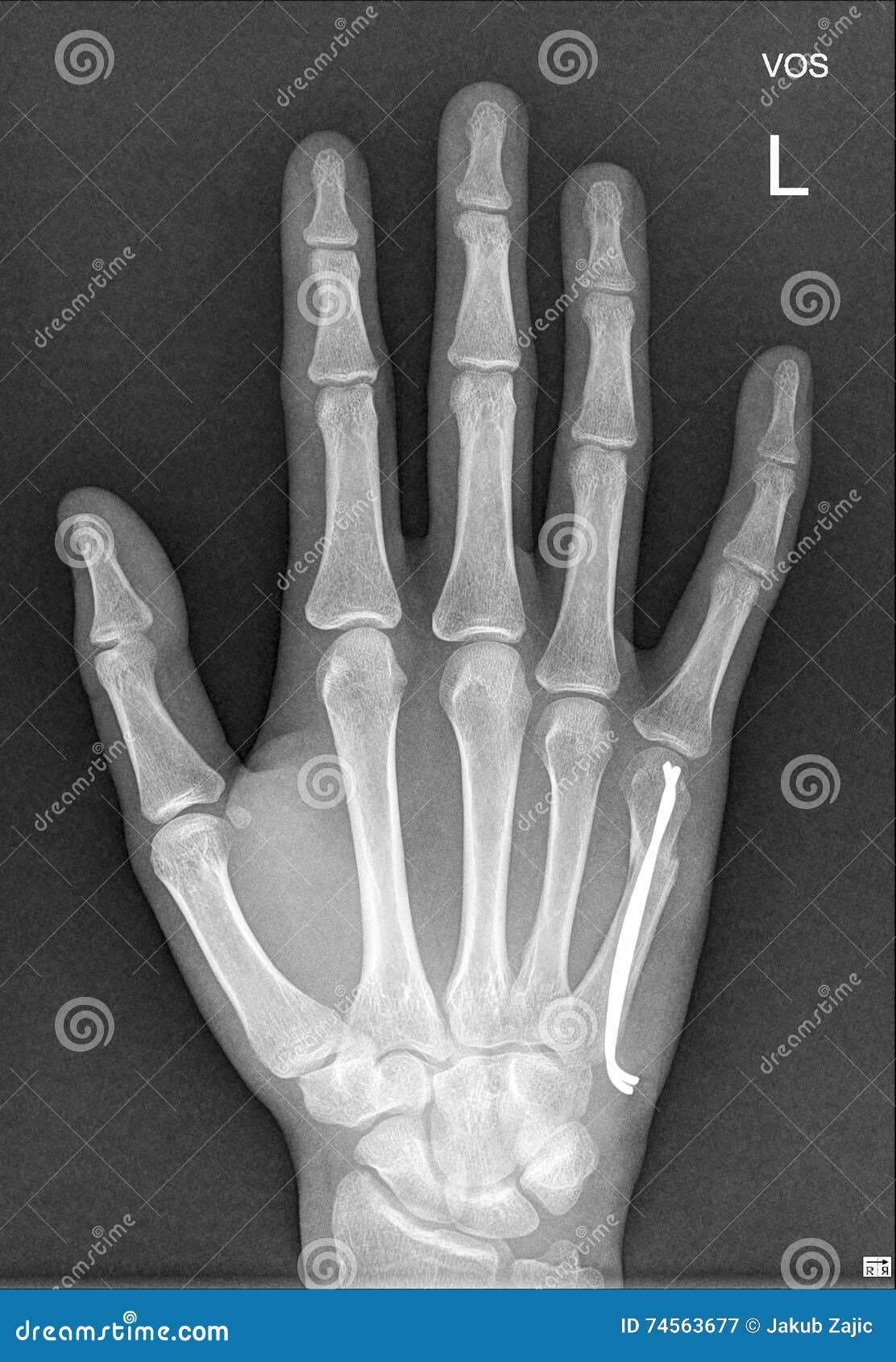 X Ray Broken Finger