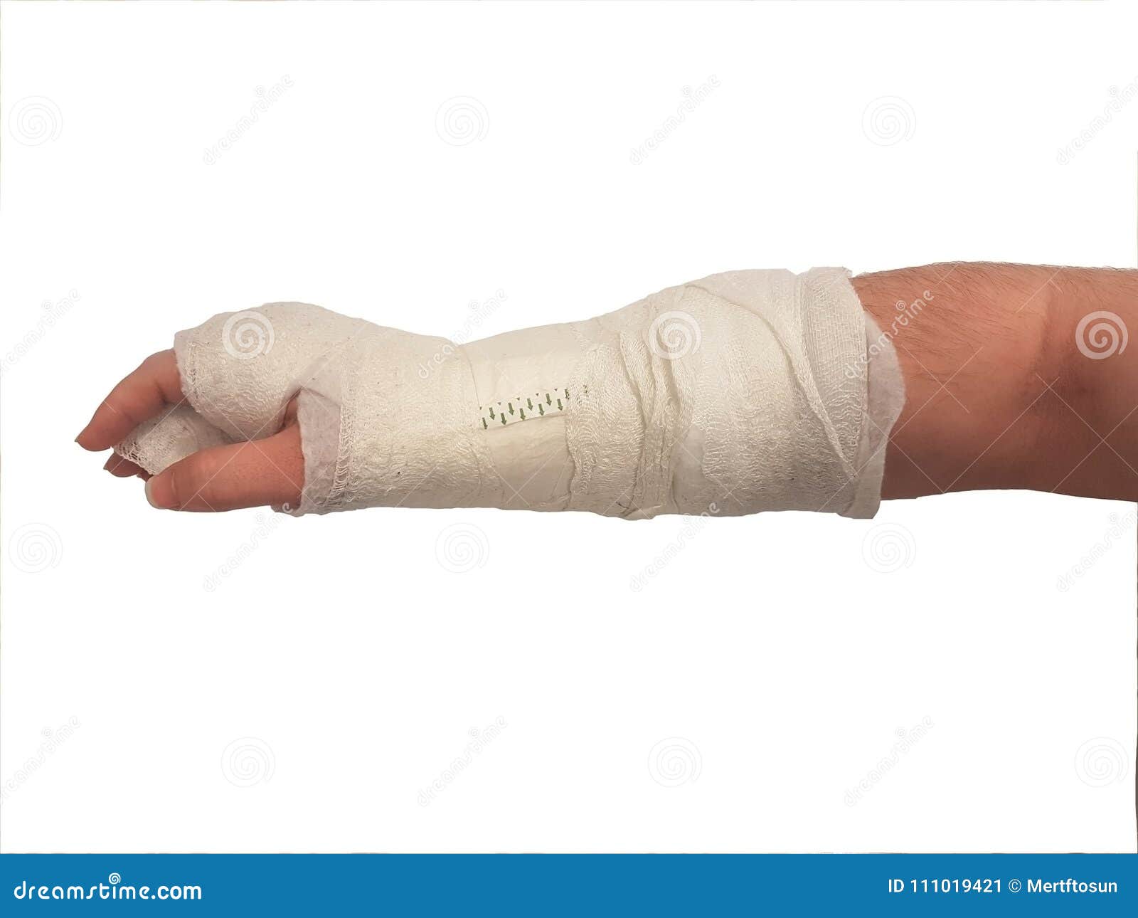 Broken Hand Plaster. Right Hand. Male. Isolated Stock Image - Image of ...