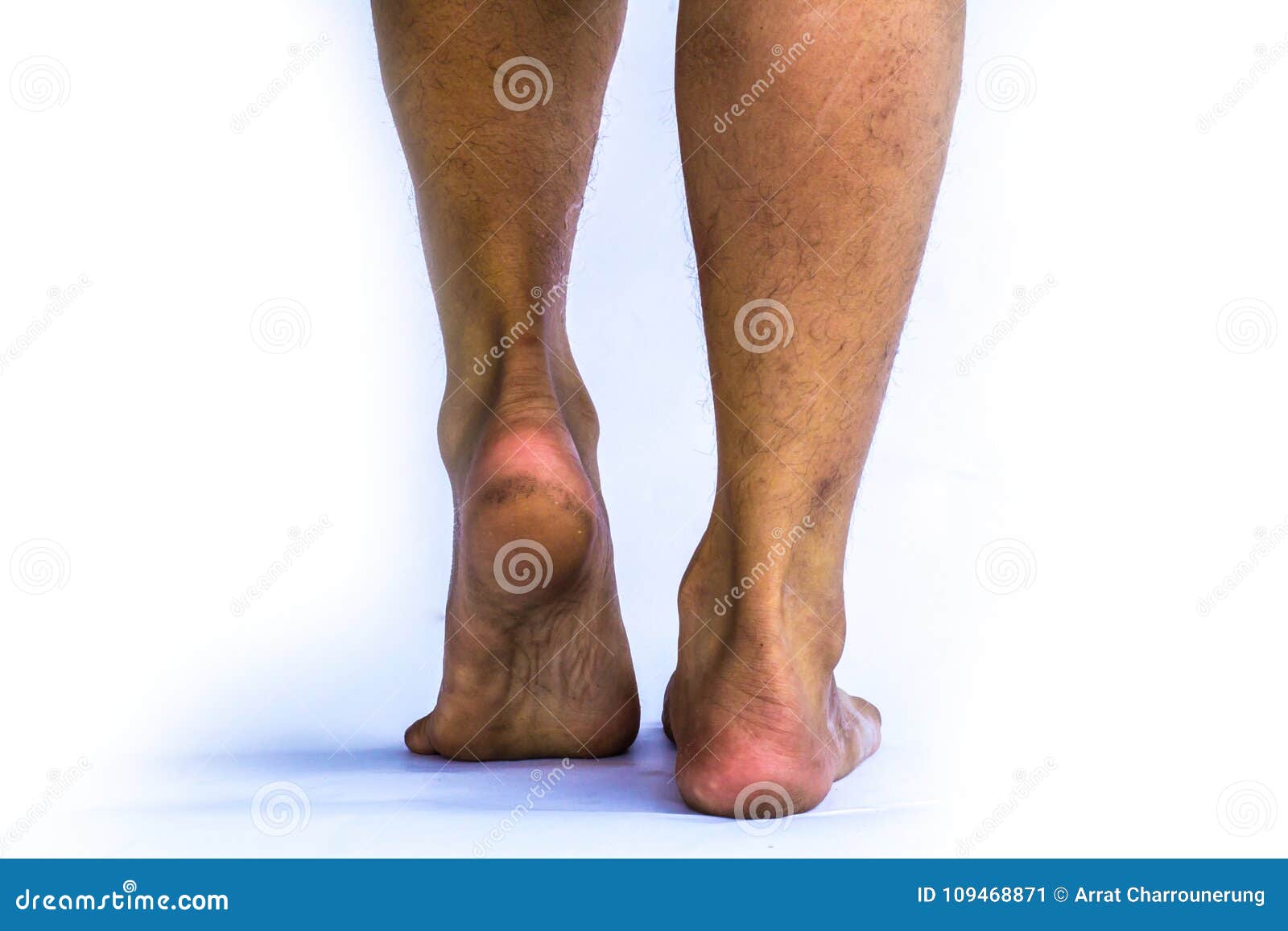Broken Heel and Dirty., Bad Healthy Skin., Bad Heel Stock Image - Image ...