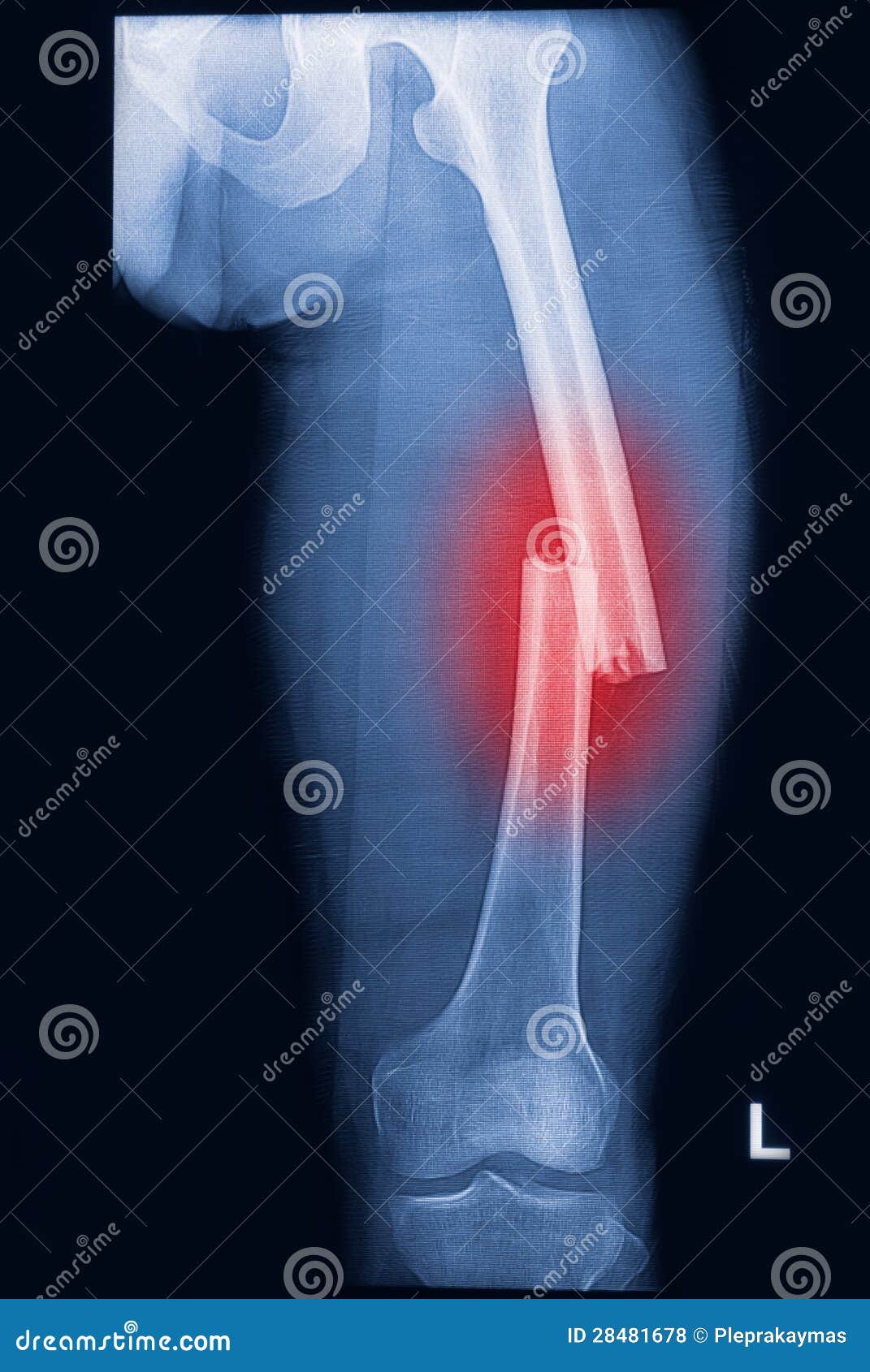 Broken Human Thigh X-rays Image Stock Photo - Image of fracture, joint ...