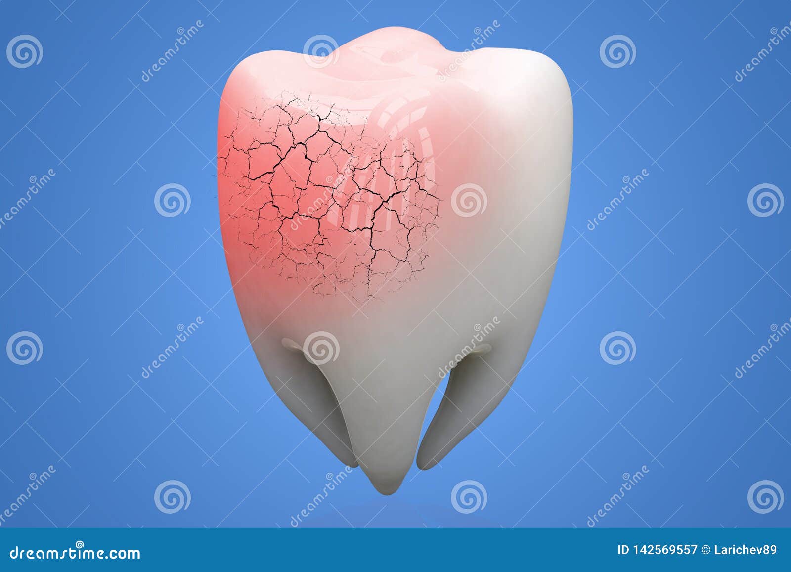 Broken Human Tooth on Blue Background. 3d Illustration Stock ...