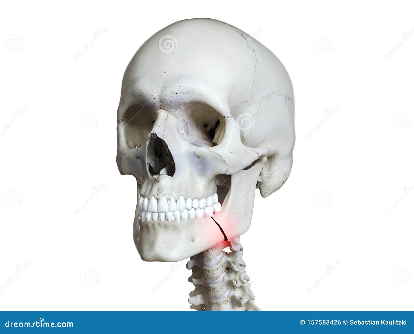 A broken jaw stock illustration. Illustration of body - 157583426