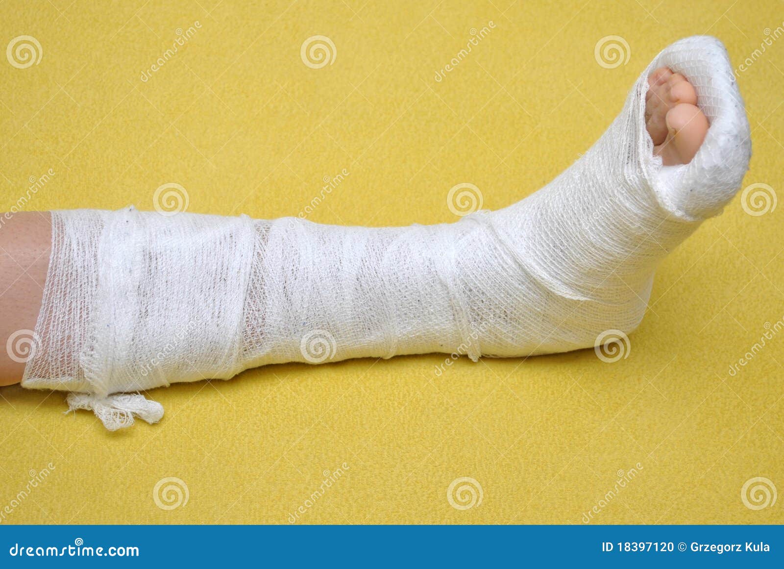 Broken leg stock photo. Image of bone, leave, fracture - 18397120