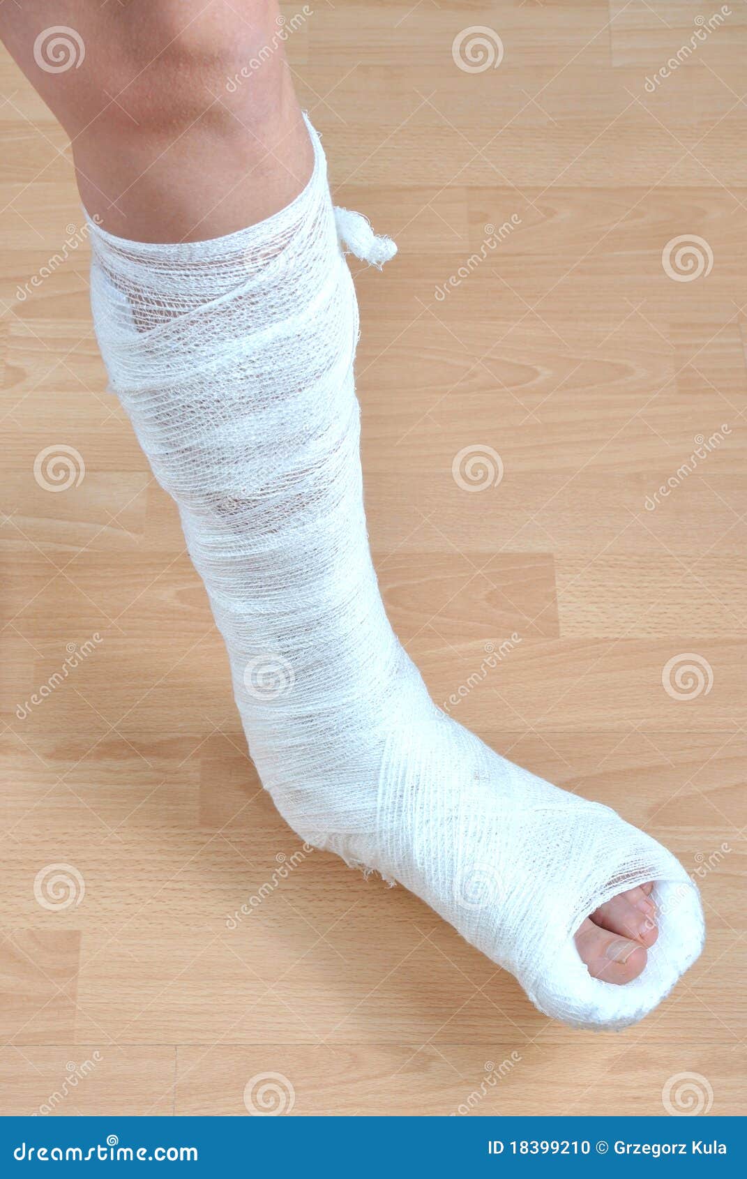 Broken leg stock photo. Image of injury, accident, bone - 18399210