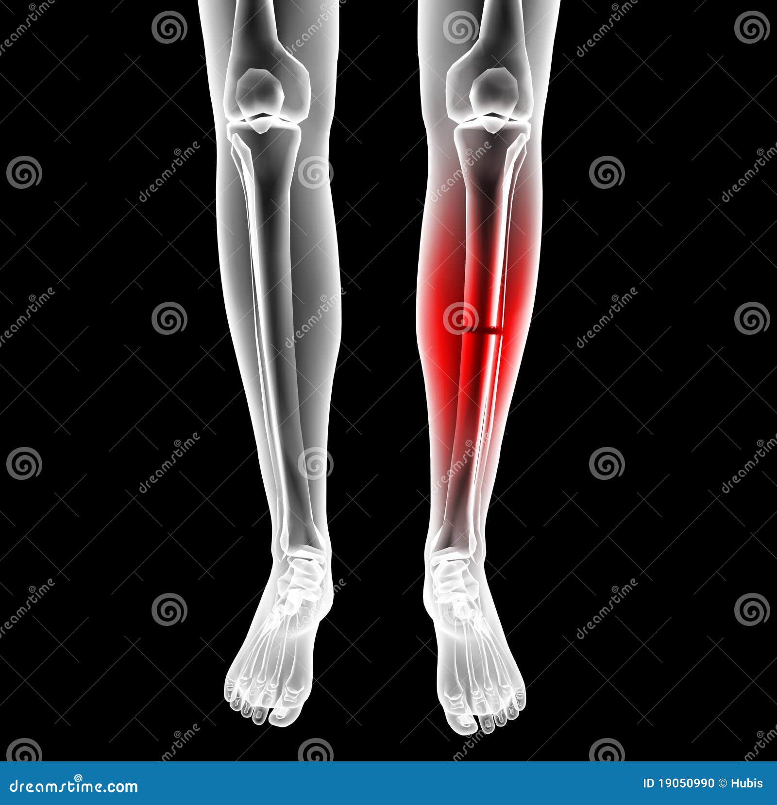 A Broken Tibia Stock Illustration | CartoonDealer.com #157583551