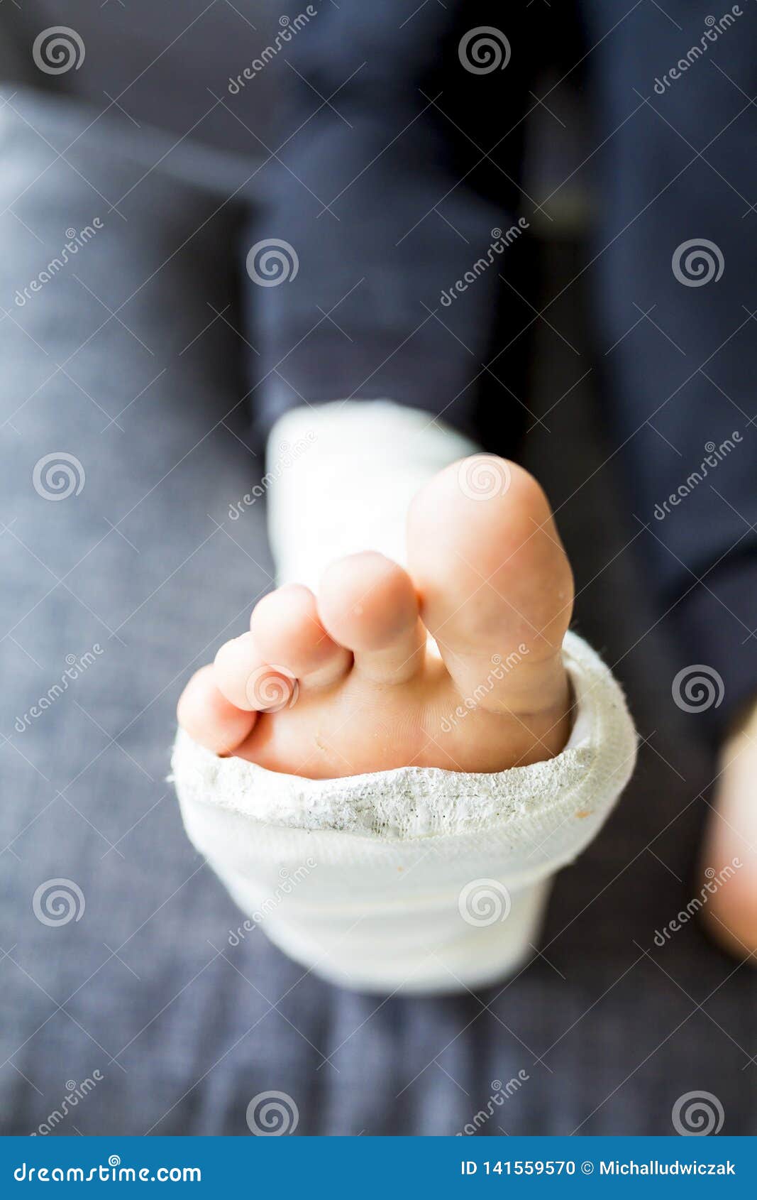 Broken Leg in a Cast during Treatment Stock Photo - Image of adult ...