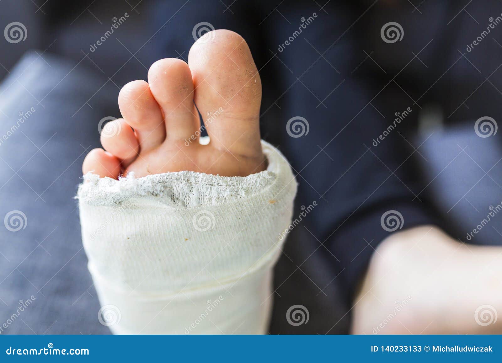 Broken Leg in a Cast during Treatment Stock Image - Image of closeup ...