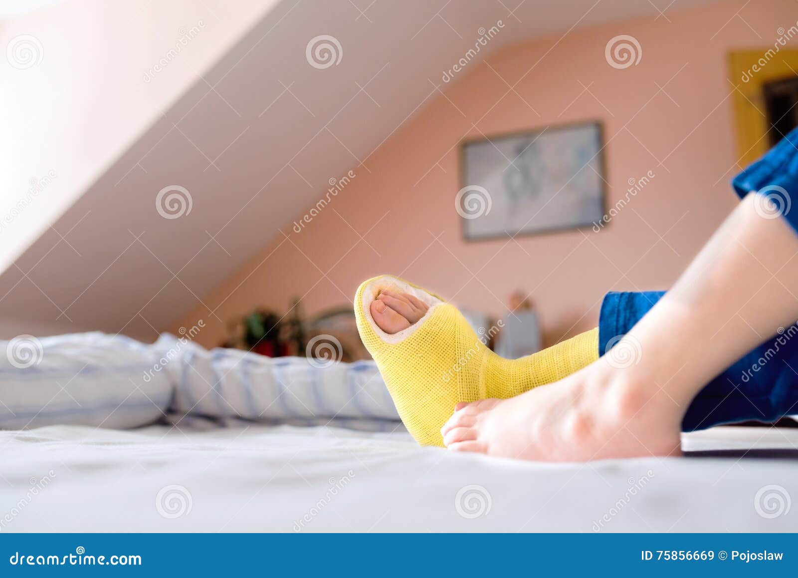 Broken Leg in Cast of Unrecognizable Little Boy. Stock Image - Image of ...