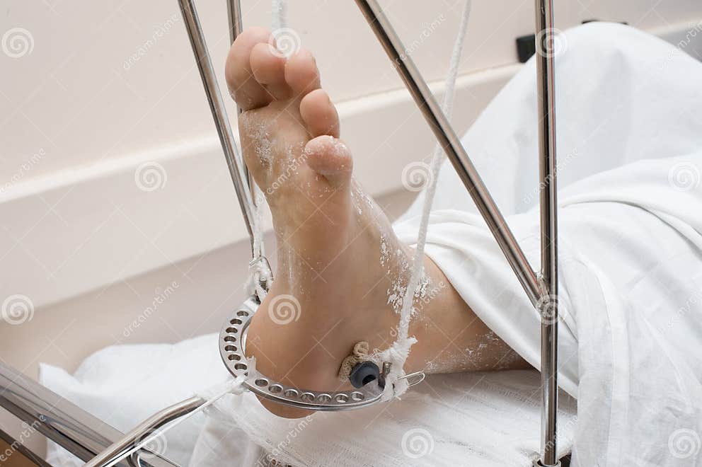 Leg with metal fixator stock image. Image of broken, chromium - 29846083